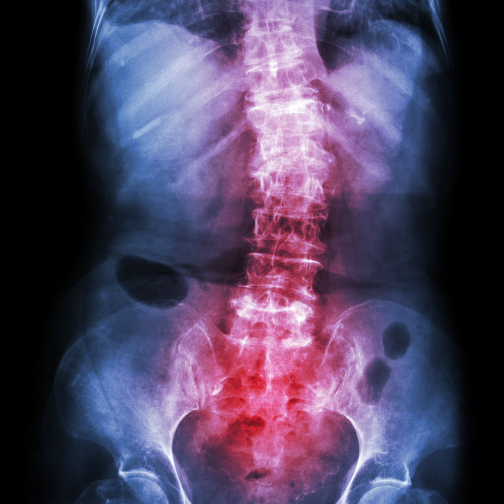 Escoliose - ITC Vertebral
