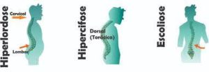 Hiperlordose e Hipercifose: Saiba o que são e como tratar! - ITC Vertebral