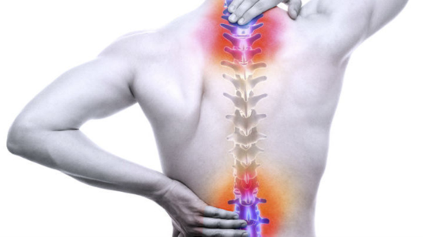 Hiperlordose e Hipercifose: Saiba o que são e como tratar! - ITC Vertebral