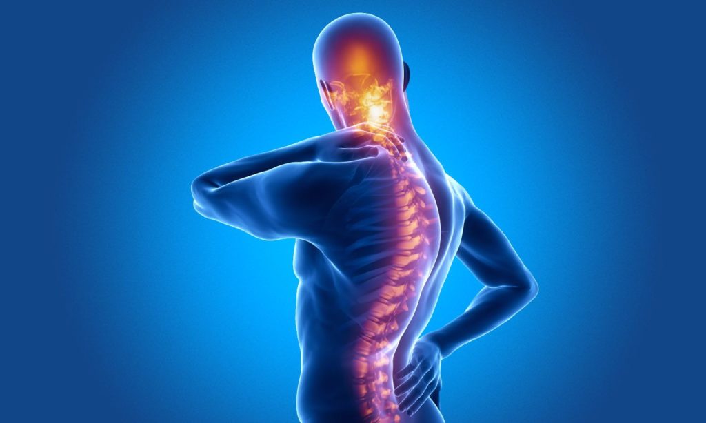 O que é espondilose cervical? - ITC Vertebral