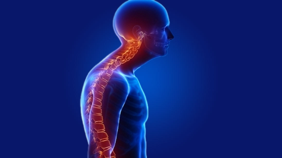 Cifose - guia completo - ITC Vertebral