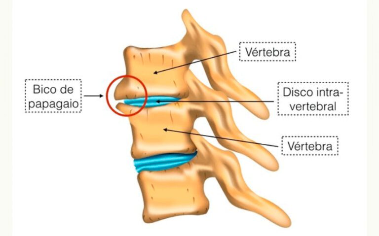 Osteófitos Marginais: o que são, sintomas e tratamento - ITC Vertebral
