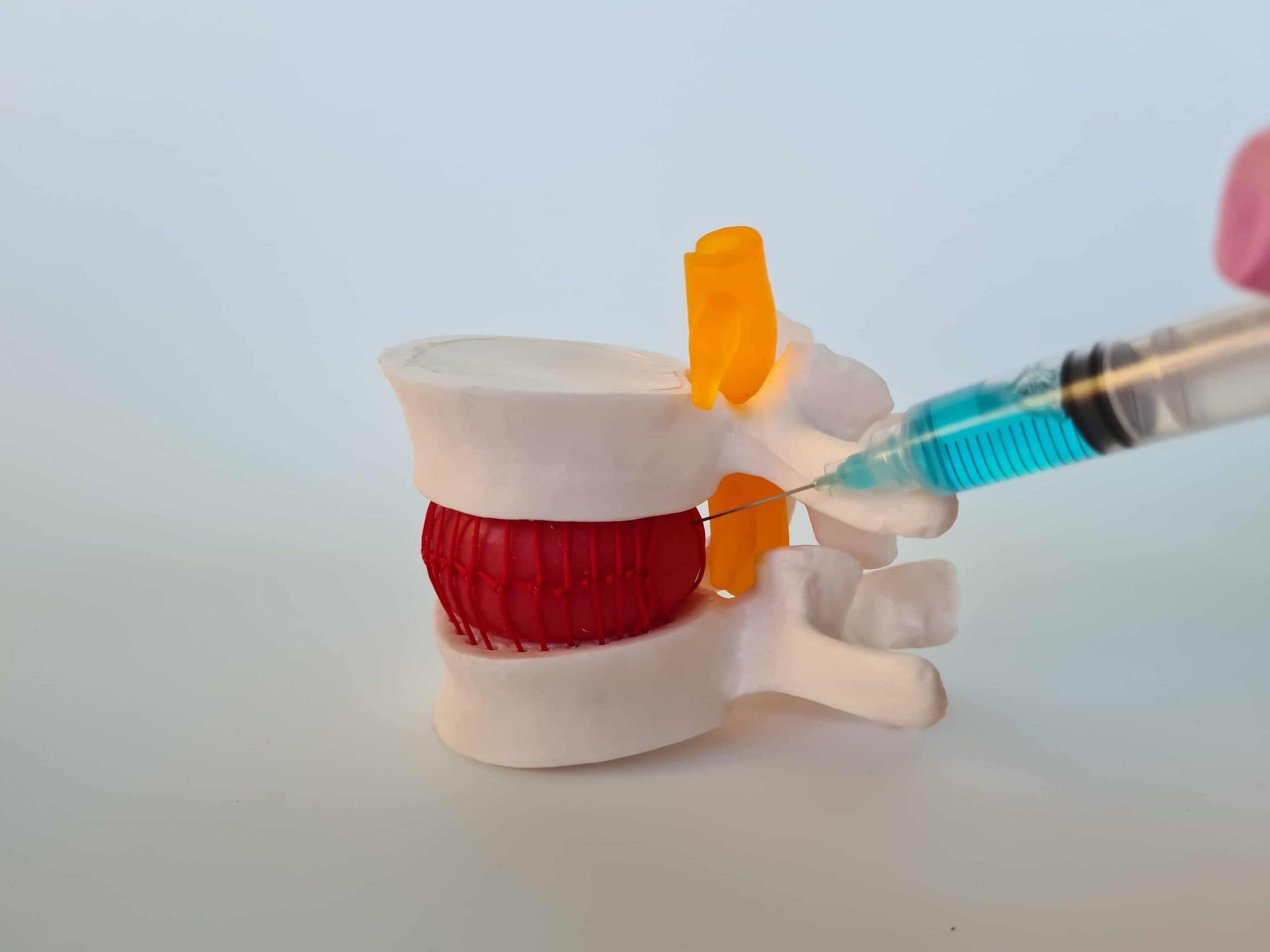 Infiltração na Coluna: o que é, como é feita, quando fazer, riscos ...