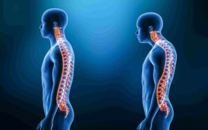 Corcunda no pescoço: causas e como resolver - ITC Vertebral