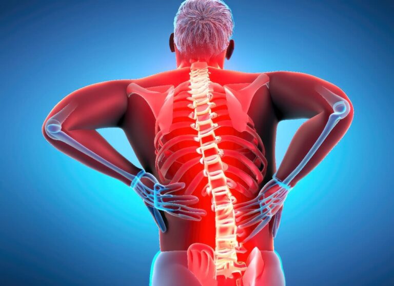 Escoliose Lombar: causas, sintomas e como tratar - ITC Vertebral