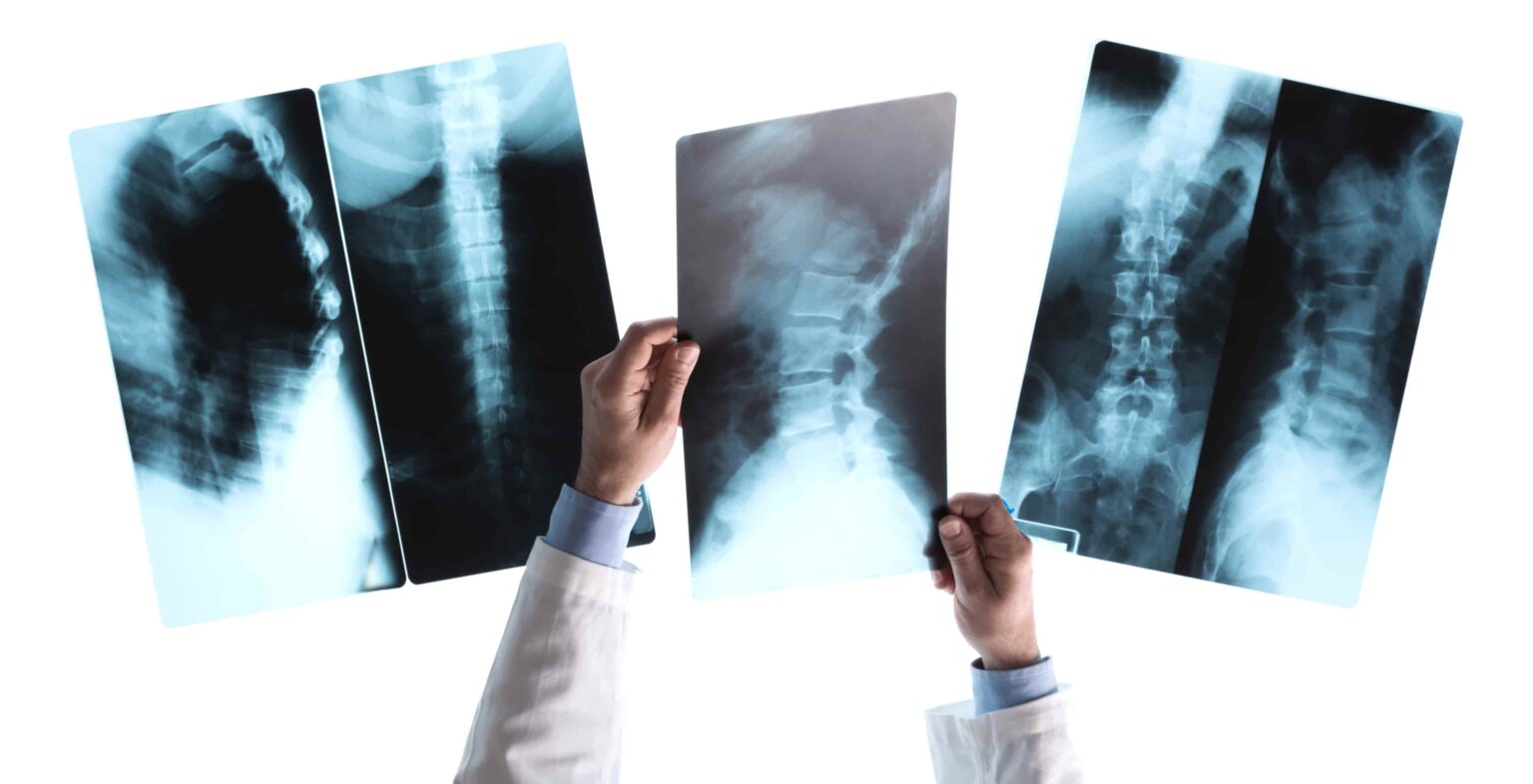 Radiografia da Coluna (raio-x coluna): quando realizar? - ITC Vertebral
