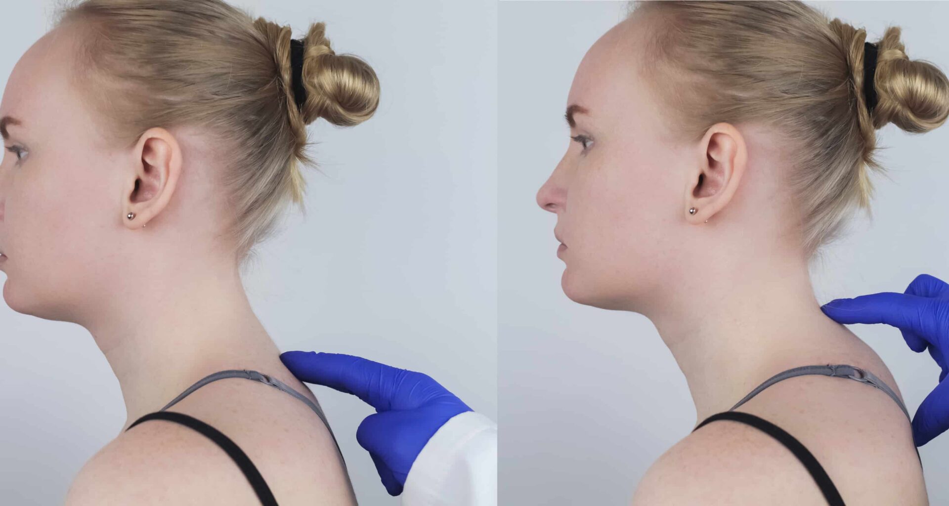 Por que a pessoa fica Corcunda? - ITC Vertebral