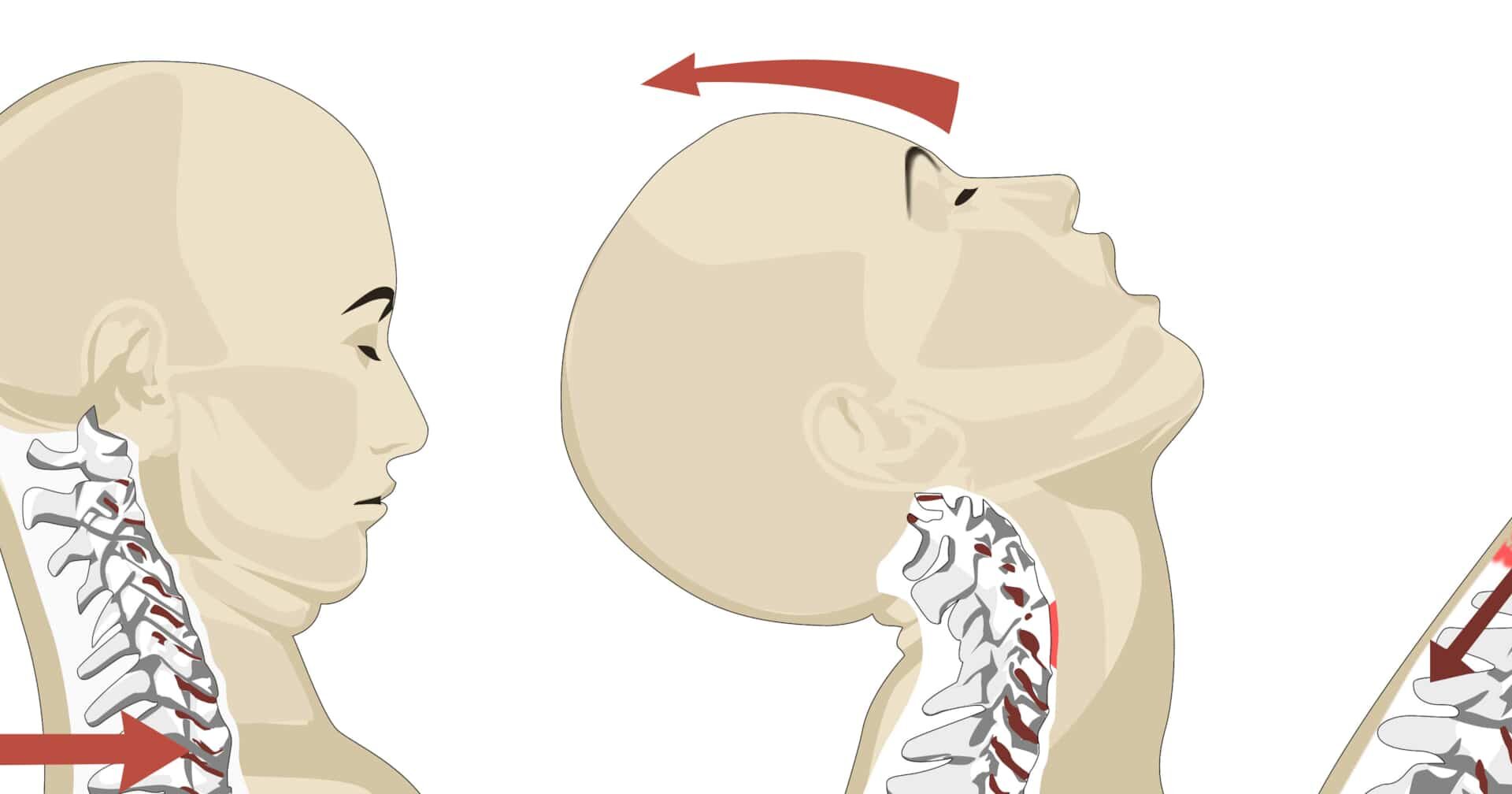 Você sabe o que é o efeito chicote (pescoço)? - ITC Vertebral
