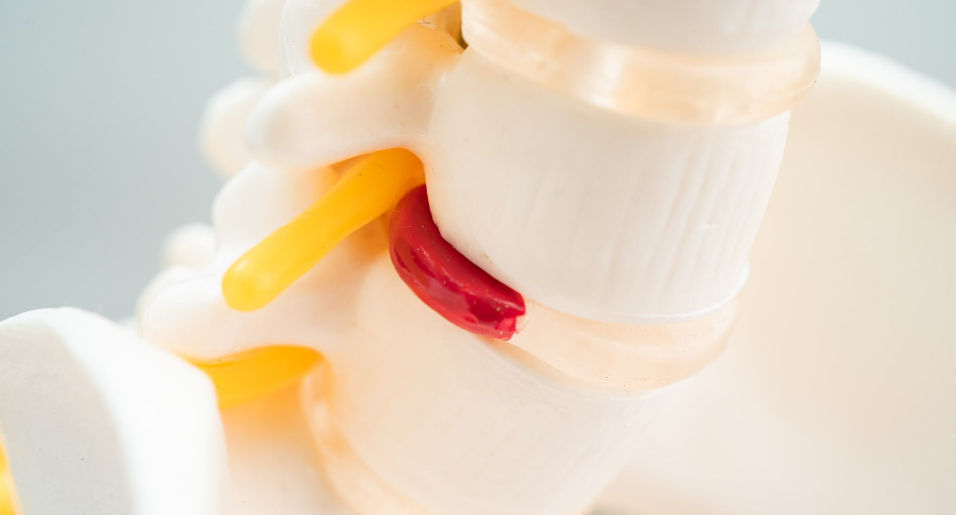 Hérnia de disco lombar L4 e L5: sintomas - ITC Vertebral