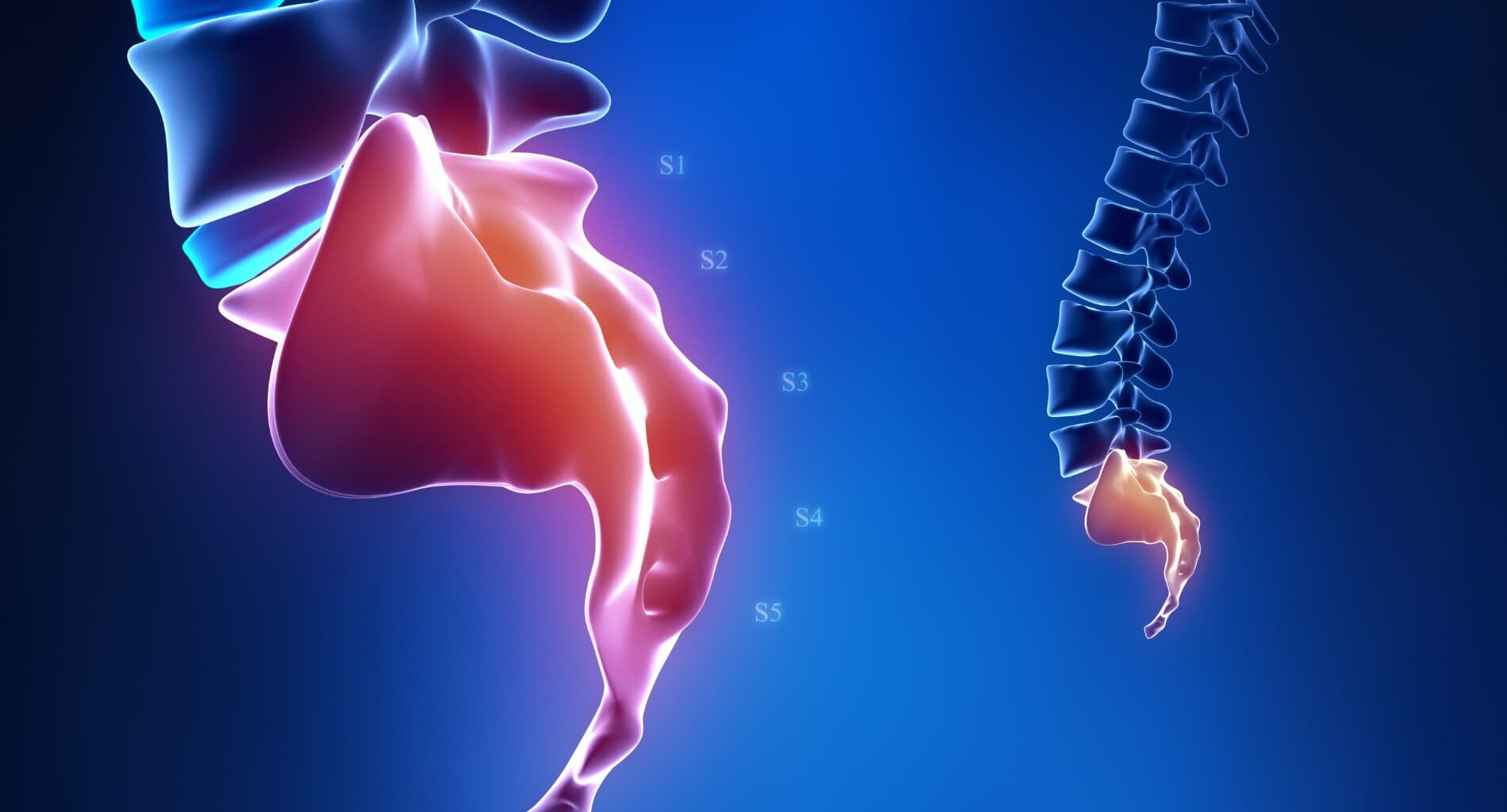 O que pode ser dor no sacro? - ITC Vertebral
