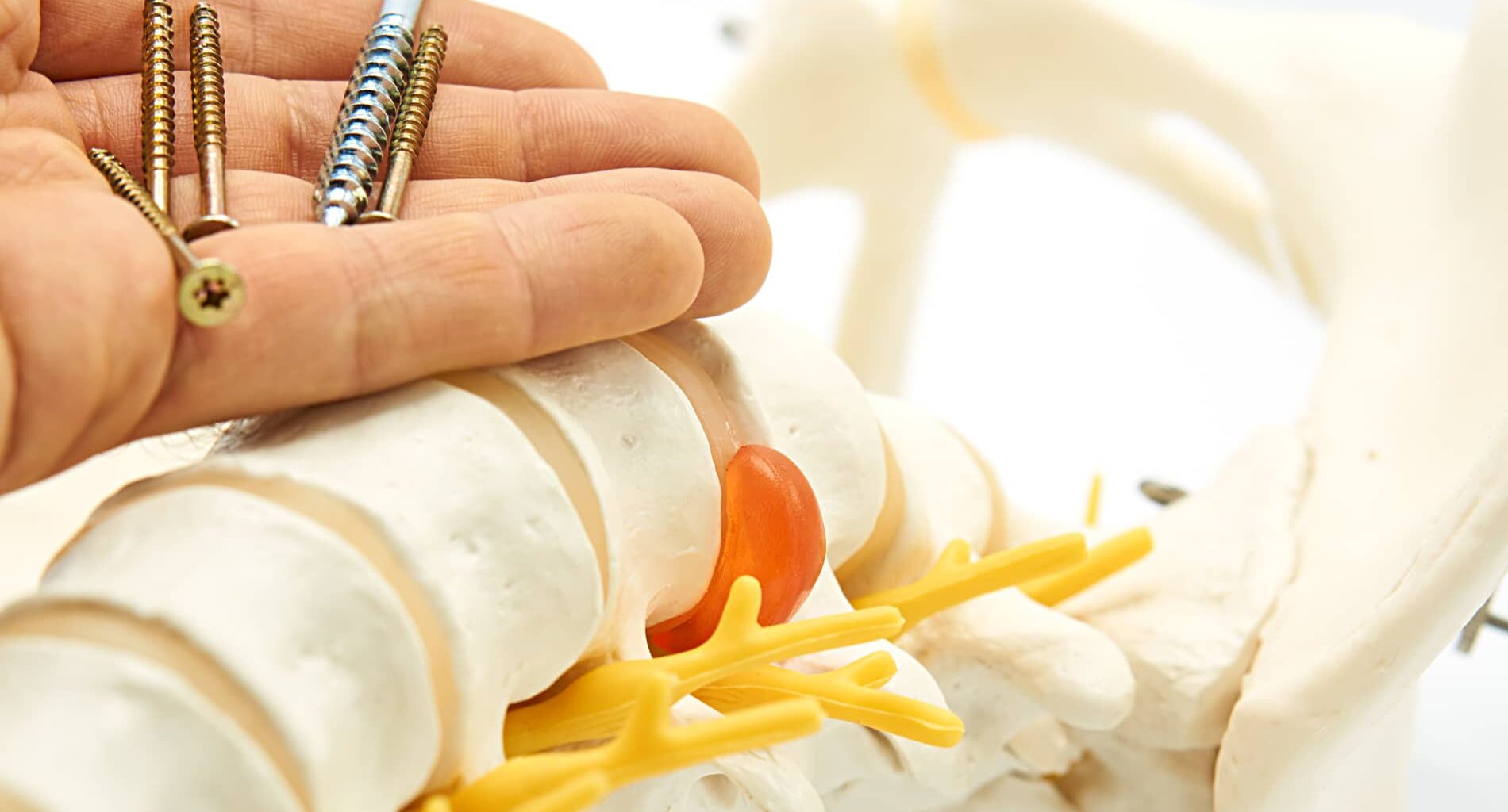 15 Perguntas Sobre Cirurgia de Coluna - ITC Vertebral