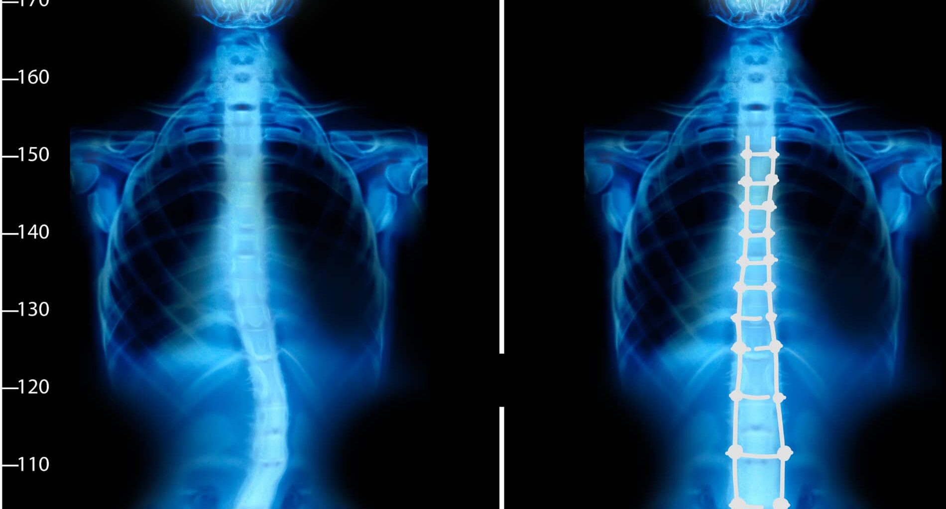 Escoliose: Quantos graus, diagnóstico, sinais, tem cura? - ITC Vertebral